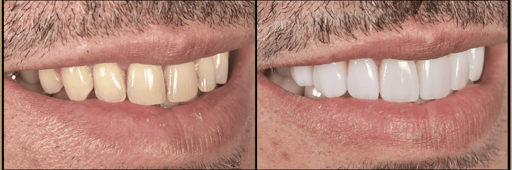 Casos de éxito | Estética Dental - Institut Autrán