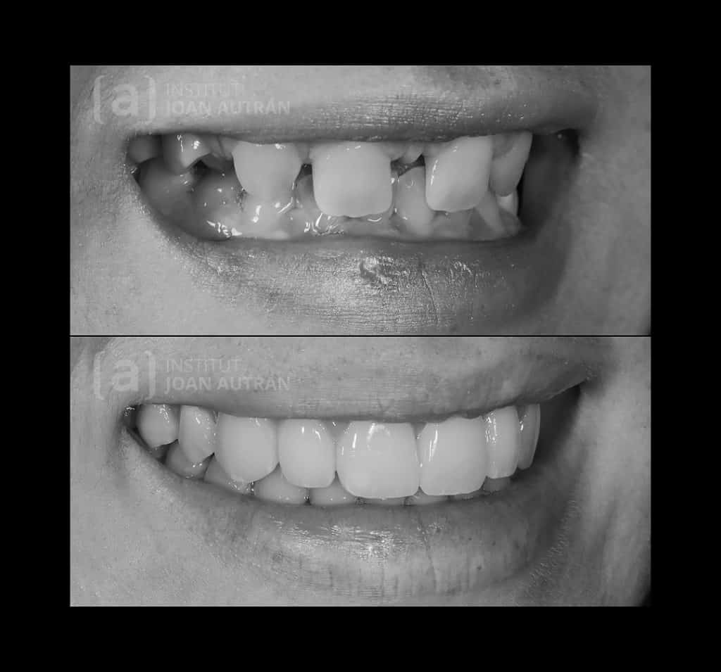 Dientes separados o diastema ¿Cómo solucionarlo? - Institut Joan Autrán