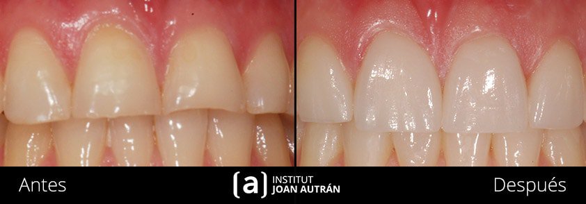 Dientes Cortos y Desgatados | Tratamiento y Solución | Institut Autrán
