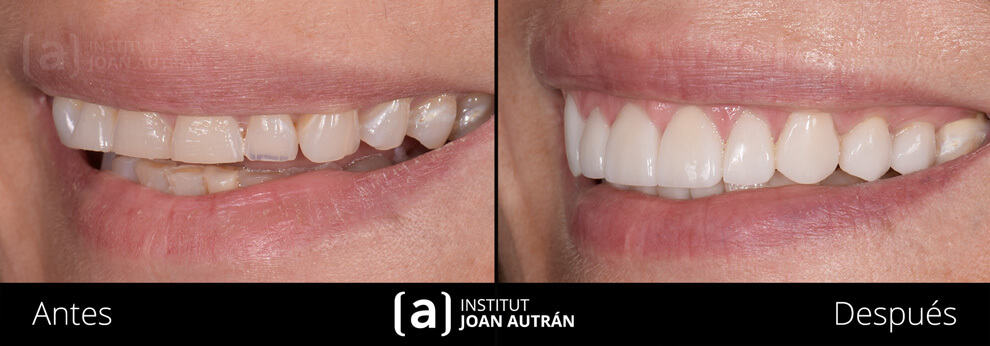 Dientes Cortos y Desgatados | Tratamiento y Solución | Institut Autrán