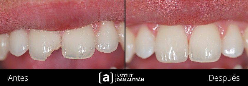 Casos de dientes rotos | Tratamientos estética dental Joan Autrán