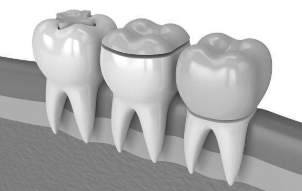 Incrustaciones dentales: causas, tipos y duración | Institut Autrán