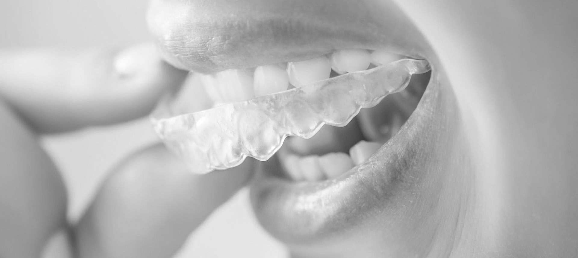 Tipos de Invisalign: Full, Lite y Teen - Institut Joan Autrán